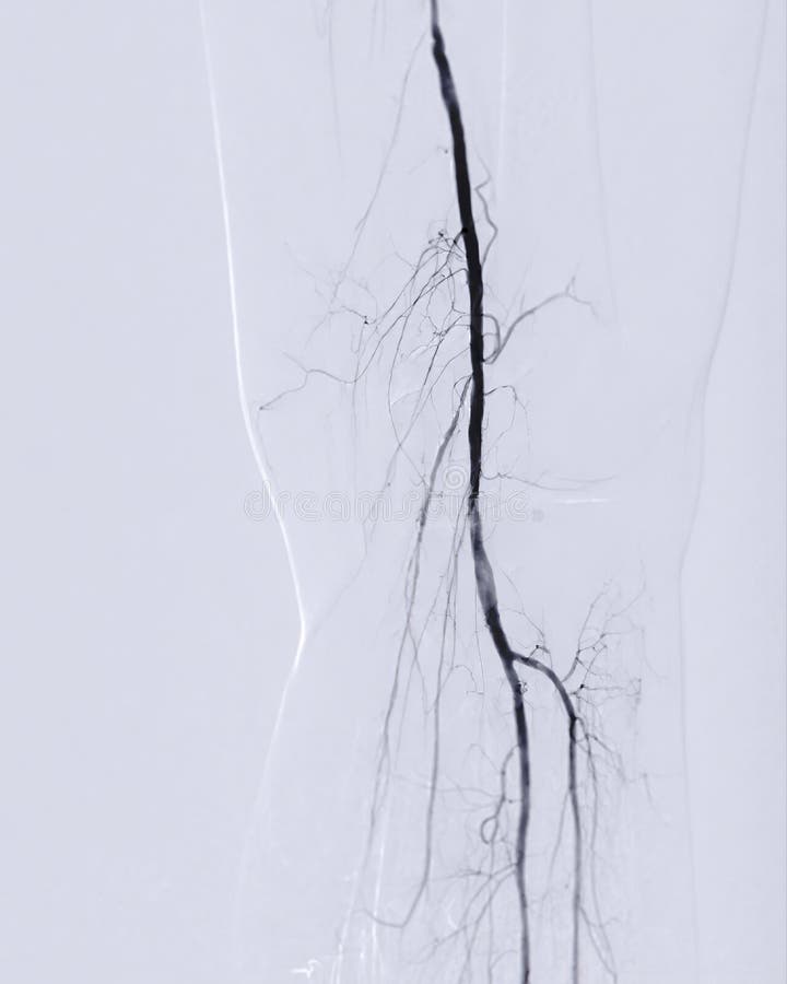 Femoral Artery Angiogram or Angiography Stock Photo - Image of media ...