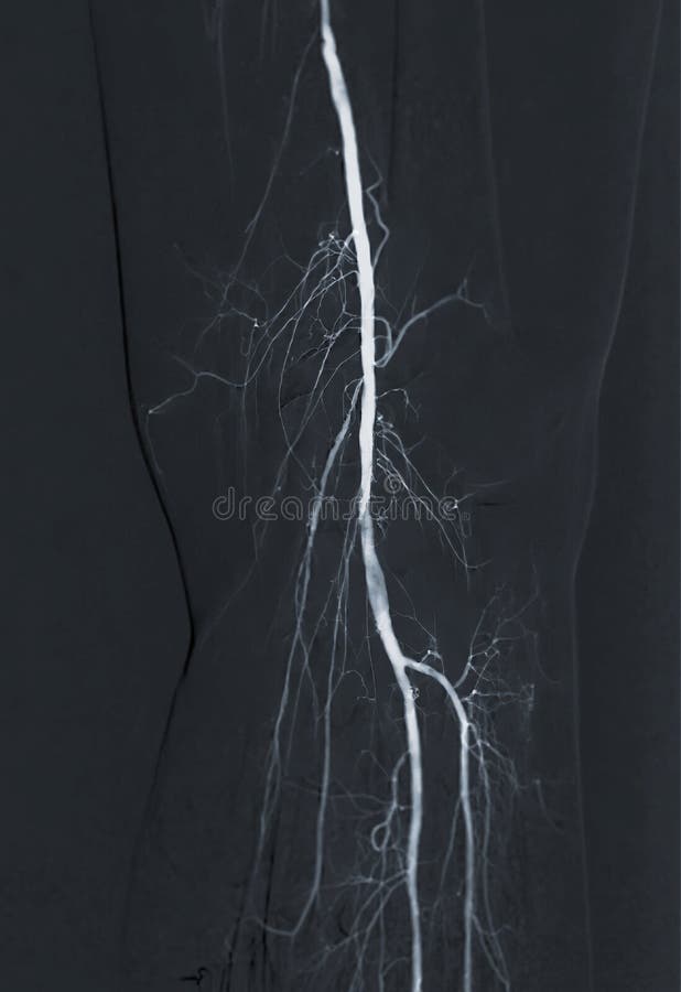 Femoral Artery Angiogram or Angiography Stock Image - Image of system ...