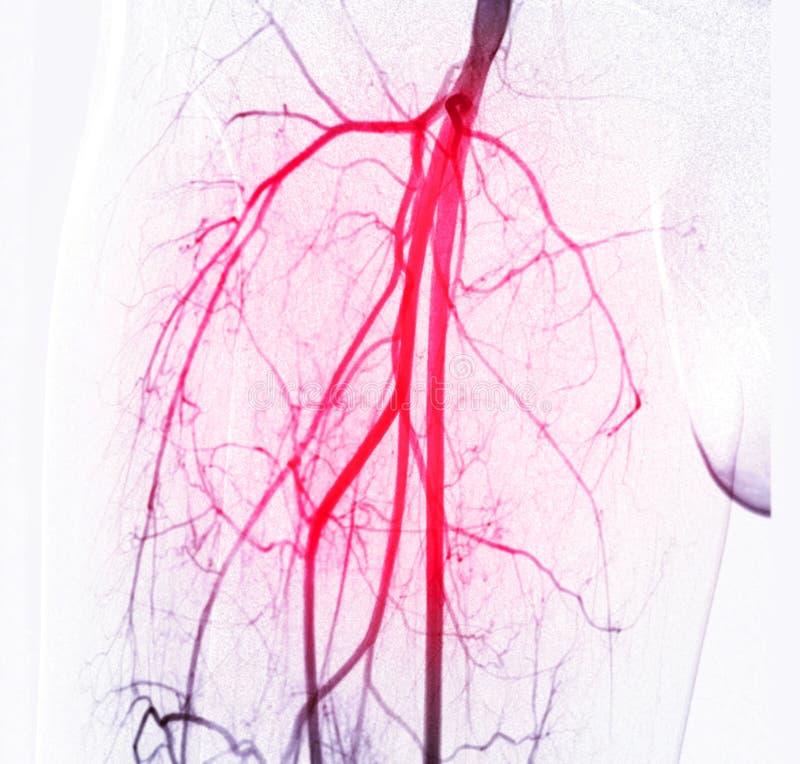 Femoral Artery Angiogram or Angiography Stock Photo - Image of arterial ...