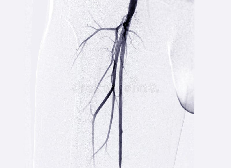 Femoral Artery Angiogram or Angiography Stock Photo - Image of femoral ...