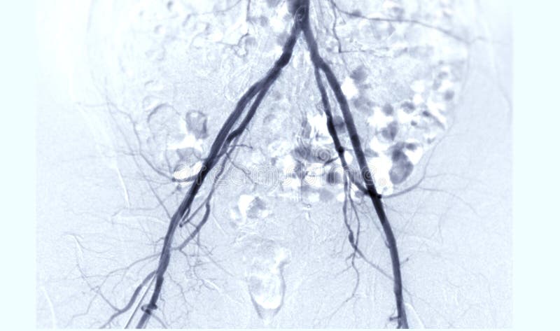 Femoral Artery Angiogram or Angiography Stock Photo - Image of arterial ...