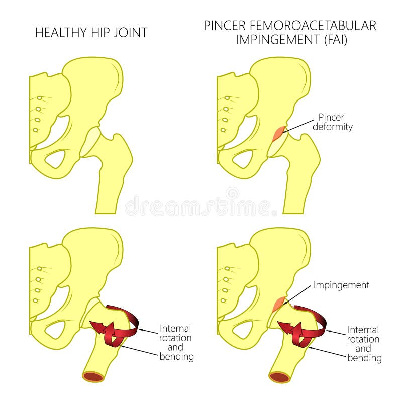 Femoroacetabular Botsing Van Heup De Gezamenlijke Problem_Pincer Vector ...
