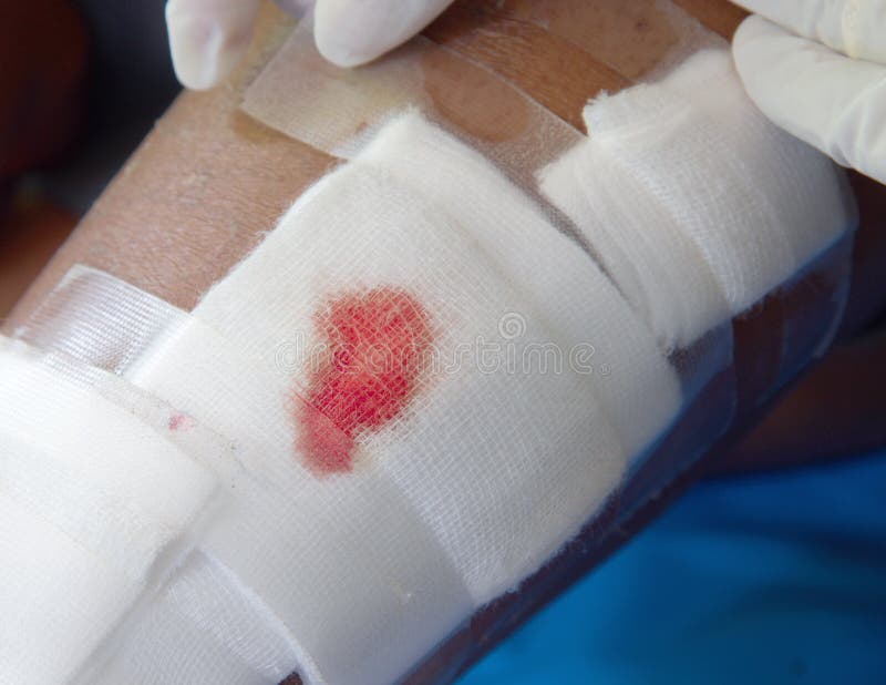 Ferida da gaze foto de stock. Imagem de cuidado, medicina - 43444604