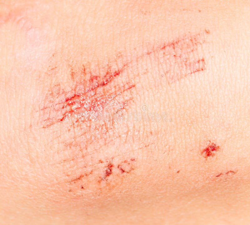 Ferida na pele Close-up foto de stock. Imagem de adulto - 100409626
