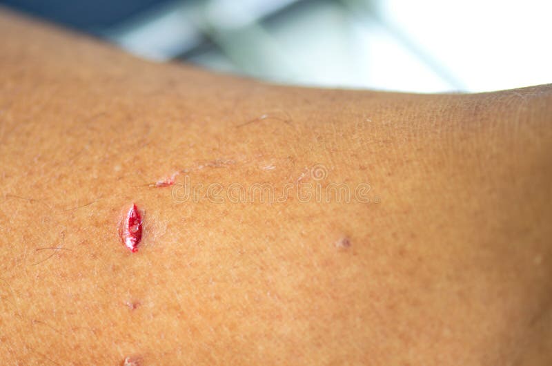 Morso Di Cane Sulla Gamba - Ferita Immagine Stock - Immagine di ...