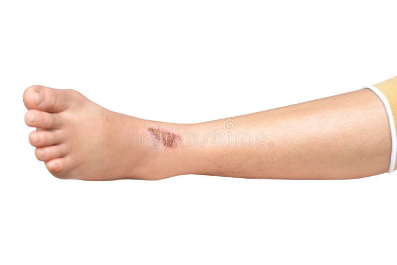 Foto Stock e immagini a tema Ferite - Scarica 3,960 foto