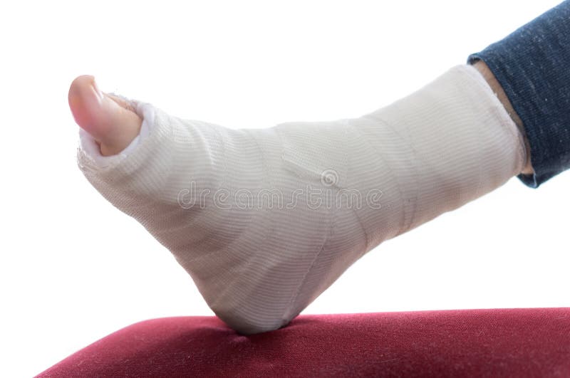 Fiberglass Plaster Leg Close Up Cast Toes Stock Photos - Free & Royalty ...
