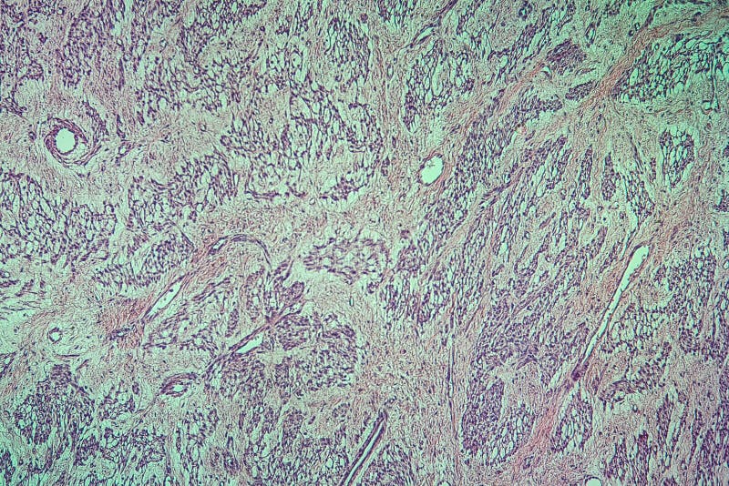 Fibromioma Do Tecido Do útero Doente Foto de Stock - Imagem de ...