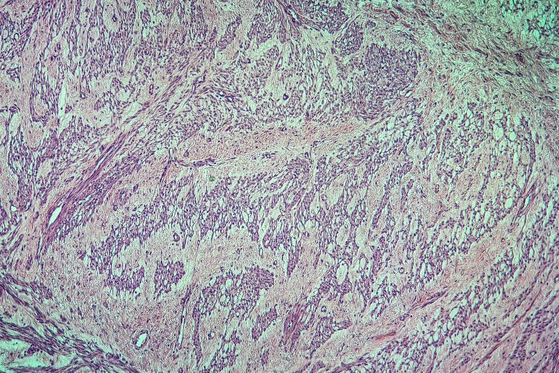 Fibromyoma of the Uterus Diseased Tissue Stock Photo - Image of cells ...