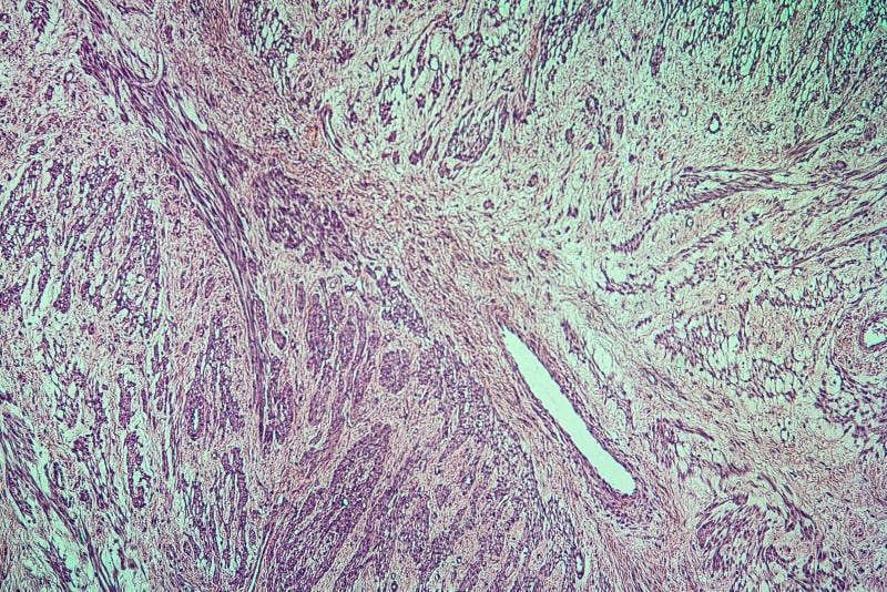 Fibromyoma of the Uterus Diseased Tissue Stock Photo - Image of ...