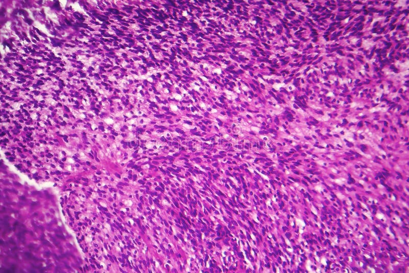 Fibrosarcoma, Bösartiger Tumor Von Fibroblasten Stockfoto - Bild von ...