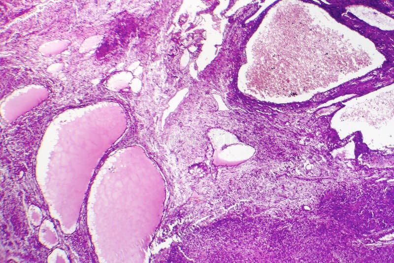 Fibrosarcoma, Tumore Maligno Dei Fibroblasti Fotografia Stock ...