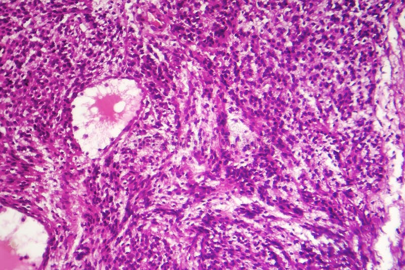 Fibrosarcoma, Tumore Maligno Dei Fibroblasti Fotografia Stock ...