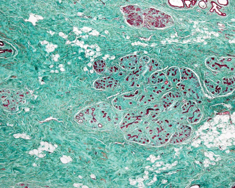 Human breast. Fibrosis stock image. Image of gland, epithelium - 230453783 Human breast. Fibrosis stock image. Image of gland, epithelium - 230453783