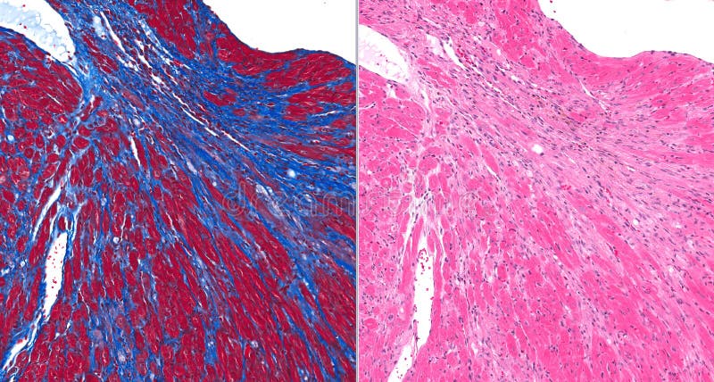 Fibrosis (scar) in heart stock image. Image of infarction - 18889677