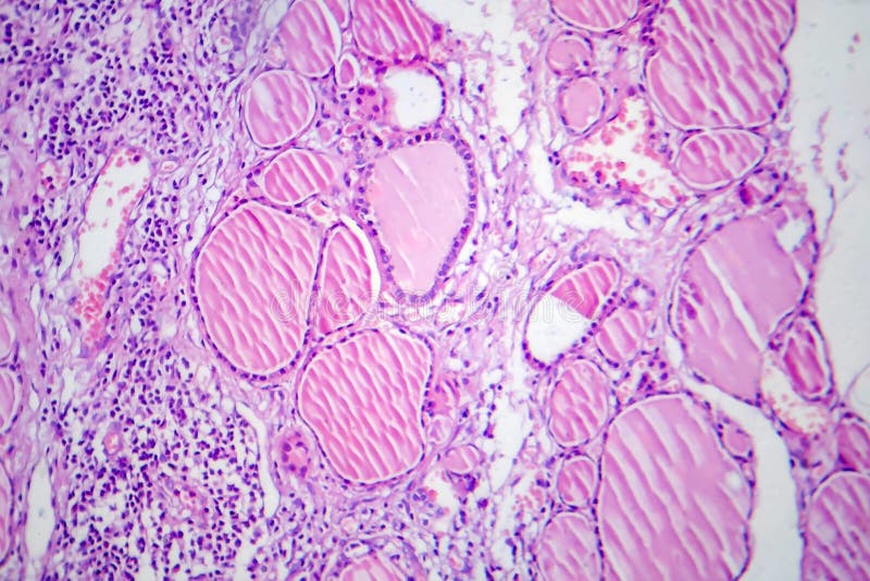 Fibrous Thyroiditis, Light Micrograph Stock Photo - Image of stain ...
