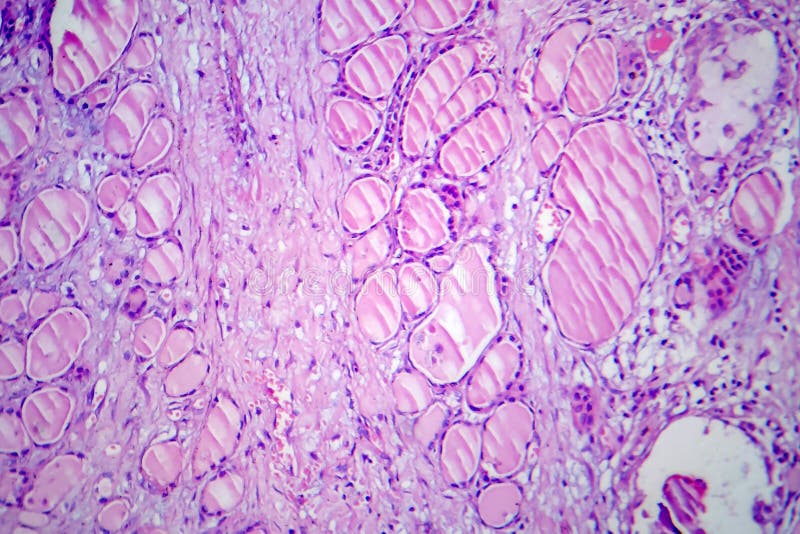 Fibrous Thyroiditis, Light Micrograph Stock Image - Image of ...