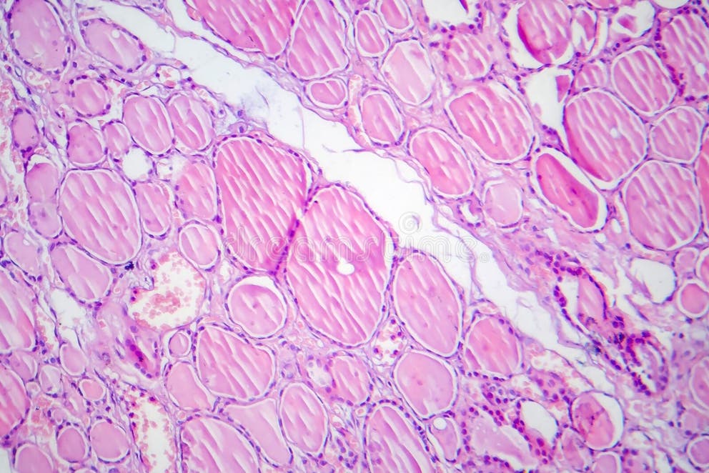 Fibrous Thyroiditis, Light Micrograph Stock Photo - Image of thyroid ...