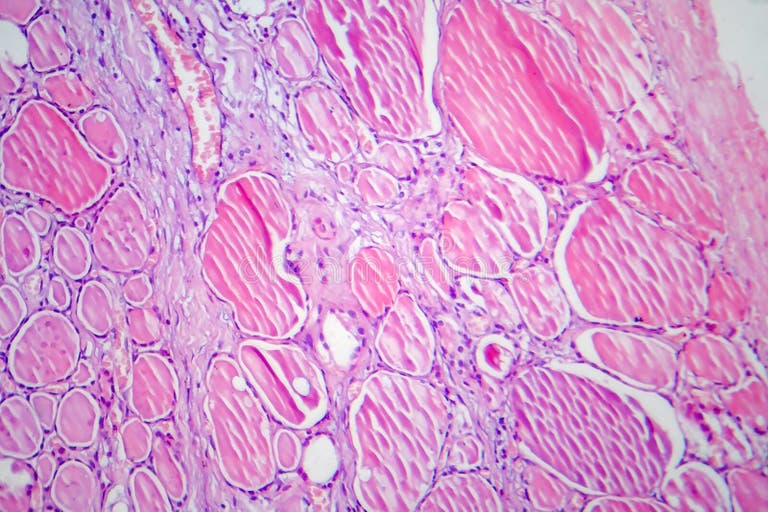 Fibrous Thyroiditis, Light Micrograph Stock Image - Image of ...