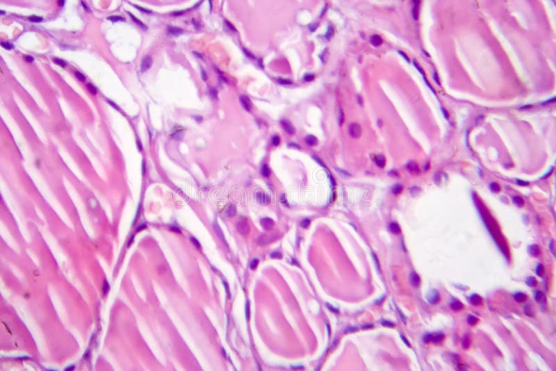 Fibrous Thyroiditis, Light Micrograph Stock Image - Image of tissue ...