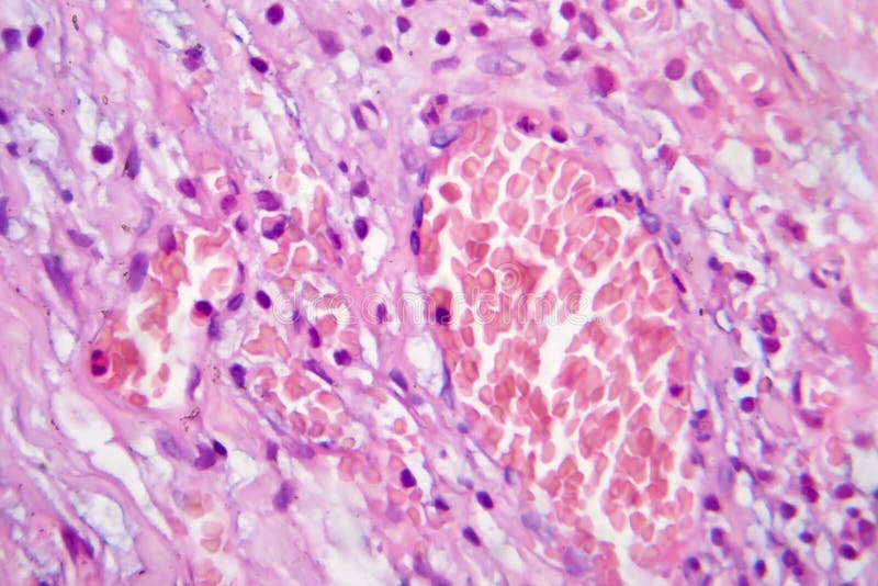 Fibrous Thyroiditis, Light Micrograph Stock Photo - Image of ...