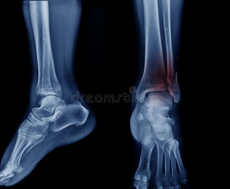 Fibular Knochenbruch stockbild. Bild von geduldig, diagnose - 123023133