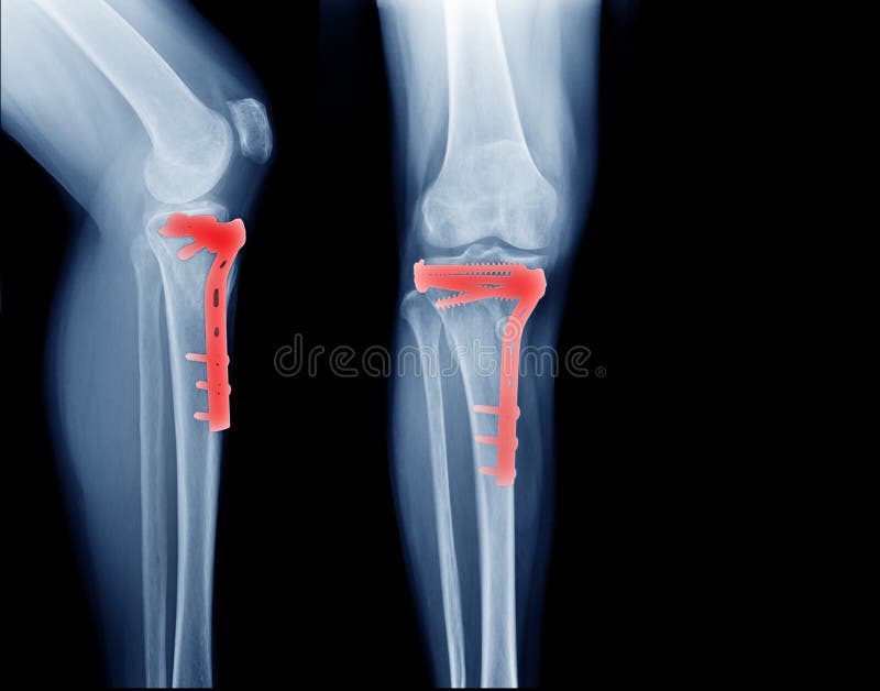 Fijación Próxima De La Tibia Imagen de archivo - Imagen de fractura ...