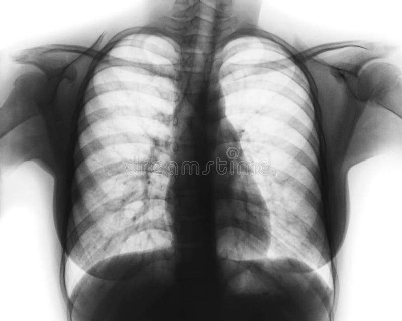 Film Chest X-ray of Normal Woman Chest Stock Image - Image of imaging ...