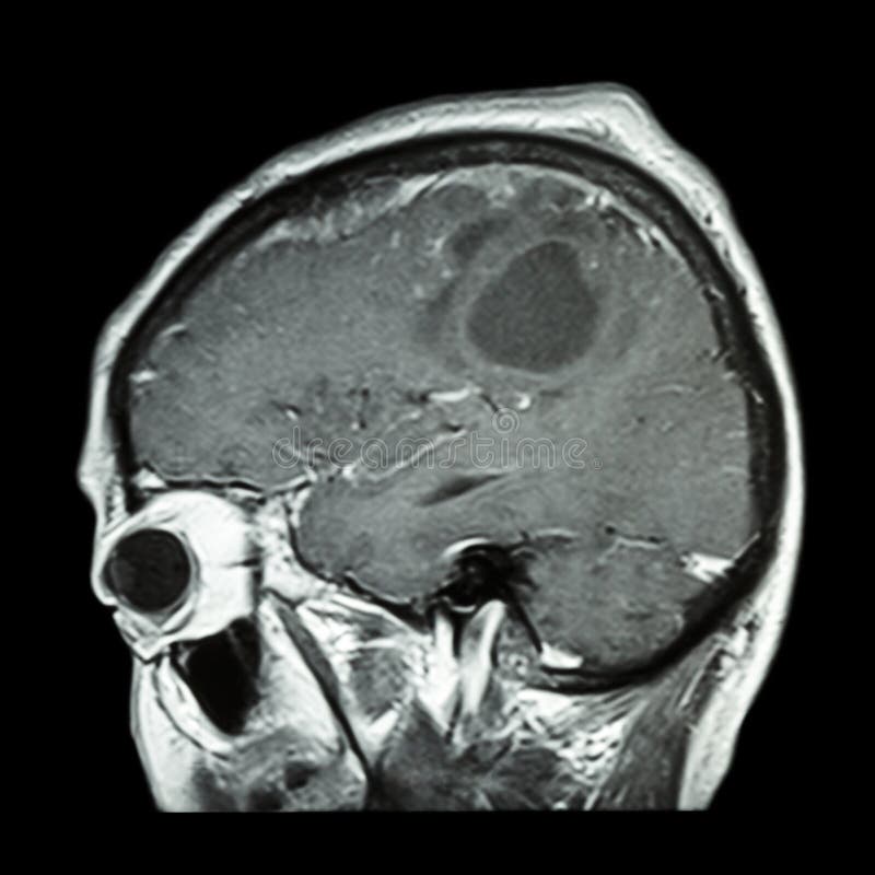 Film Mri Of Brain With Brain Tumor Sagittal Plane Side View Lateral View Medical