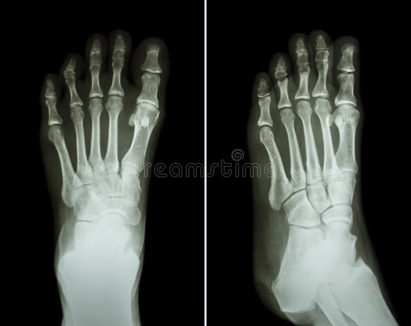 Film X-ray Both Foot ( 2 Position : Front View and Side View ) Stock ...