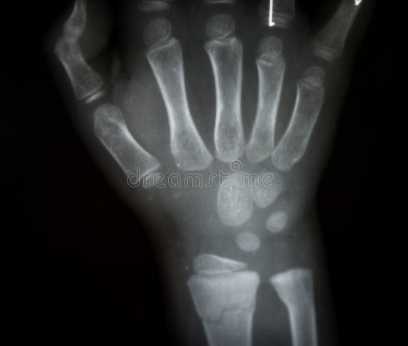 Normal xray of both hands stock photo. Image of inflammation - 24374550