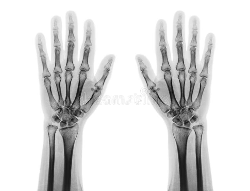 Film X-ray of Both Normal Human Hands . Front View Stock Photo - Image ...