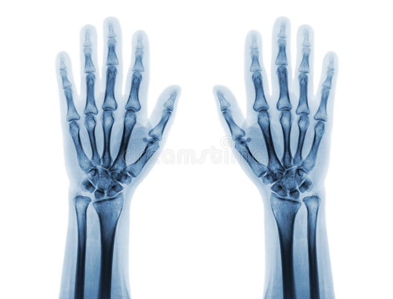 Film X-ray of Both Normal Human Hands . Front View Stock Photo - Image ...