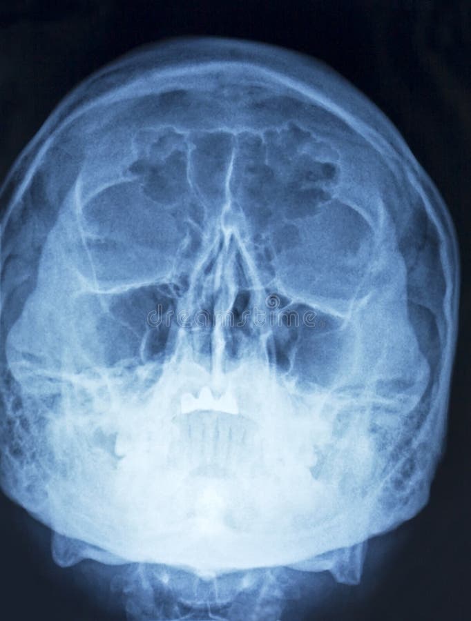 Film x-ray head stock photo. Image of medicine, people - 46678258
