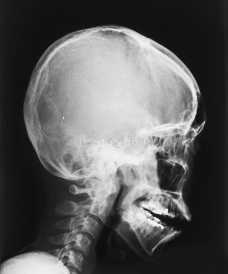 Film X-ray image of head stock image. Image of dark, examine - 77208057
