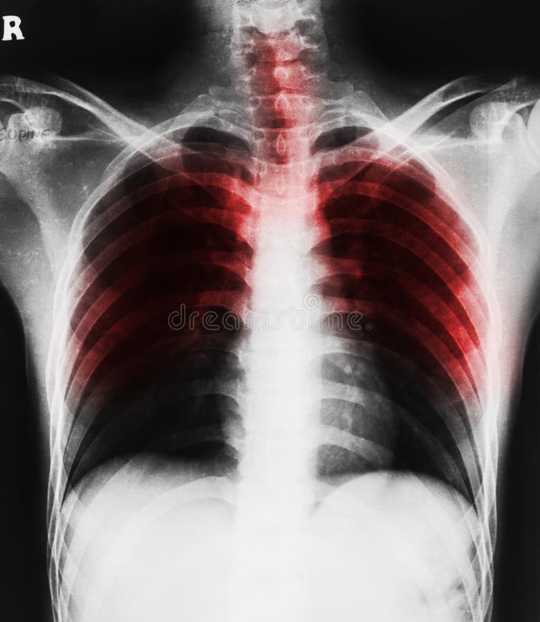 Film X-ray image of rib stock image. Image of diagnose - 77203521