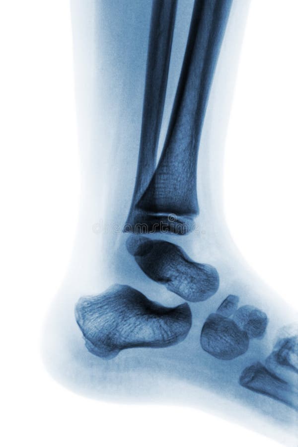X-ray Foot Lateral : Show Normal Child S Foot Stock Photo - Image of ...