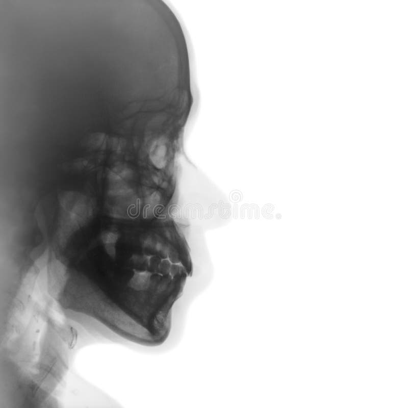 Film X-ray of Normal Human Skull . Lateral View Stock Photo - Image of ...