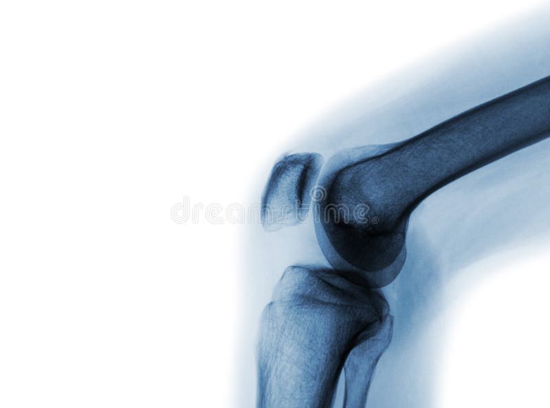 Film X-ray of Normal Knee Joint Stock Image - Image of imaging, normal ...