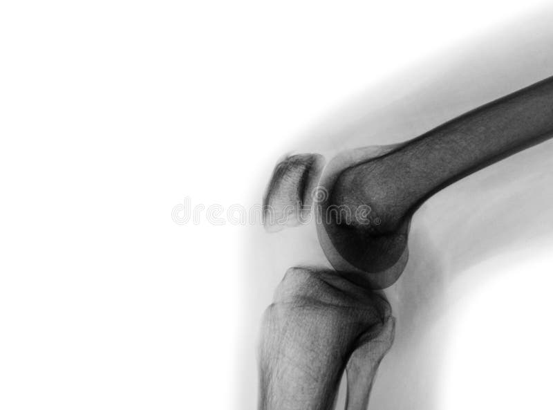 Film X-ray of Normal Knee Joint Stock Photo - Image of joint, health ...