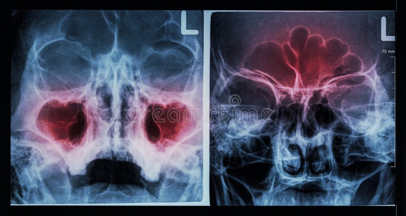 Film X-ray Paranasal Sinus : Show Sinusitis at Maxillary Sinus ( Left ...