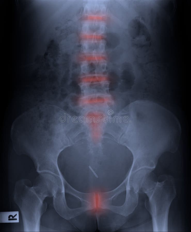 X-ray of the Pelvis and Spinal Column, Front View Stock Photo - Image ...