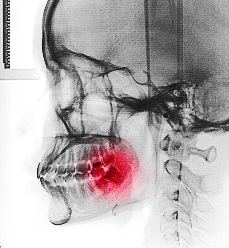 Film X-Ray Scan Human for Tooth Impaction Stock Image - Image of ...