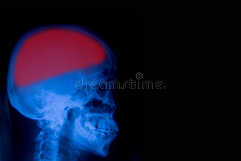 Zijde Van De Film X-ray Schedel Stock Foto - Afbeelding bestaande uit ...