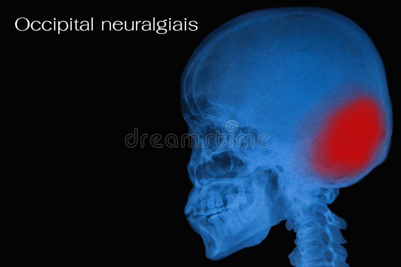 Film x-ray skull of human stock photo. Image of body - 69651918