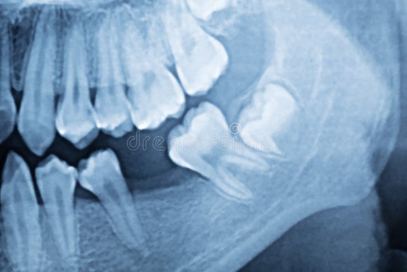 Film x-ray of teeth. stock photo. Image of dentist, film - 150677202