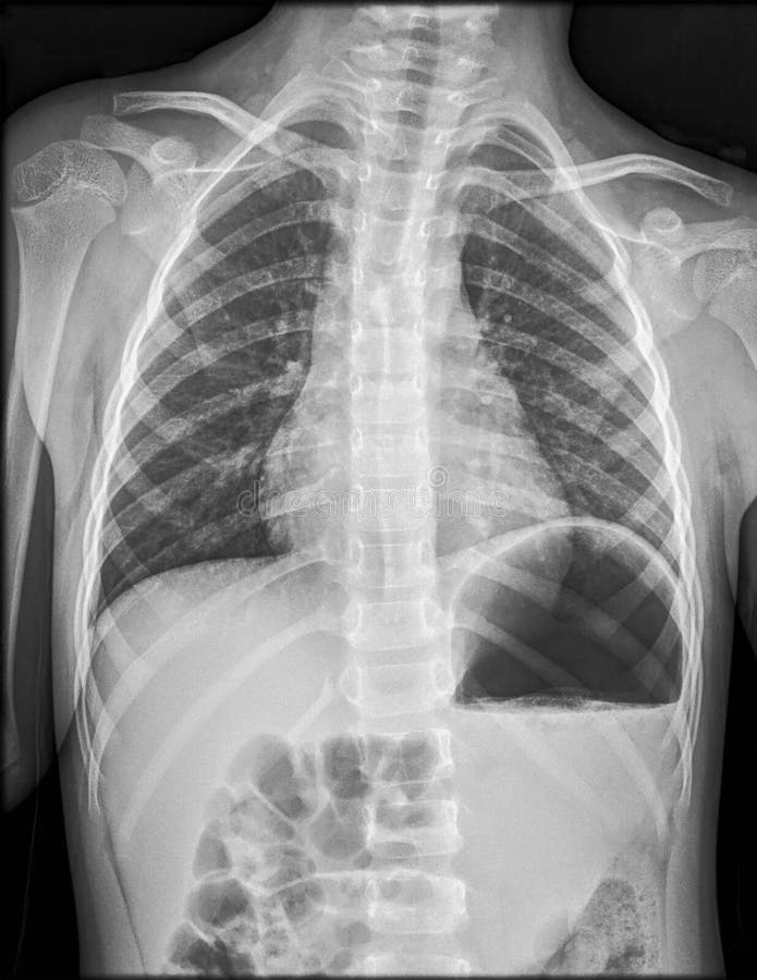 Film X-ray Upper Half Body of Child Stock Image - Image of health ...