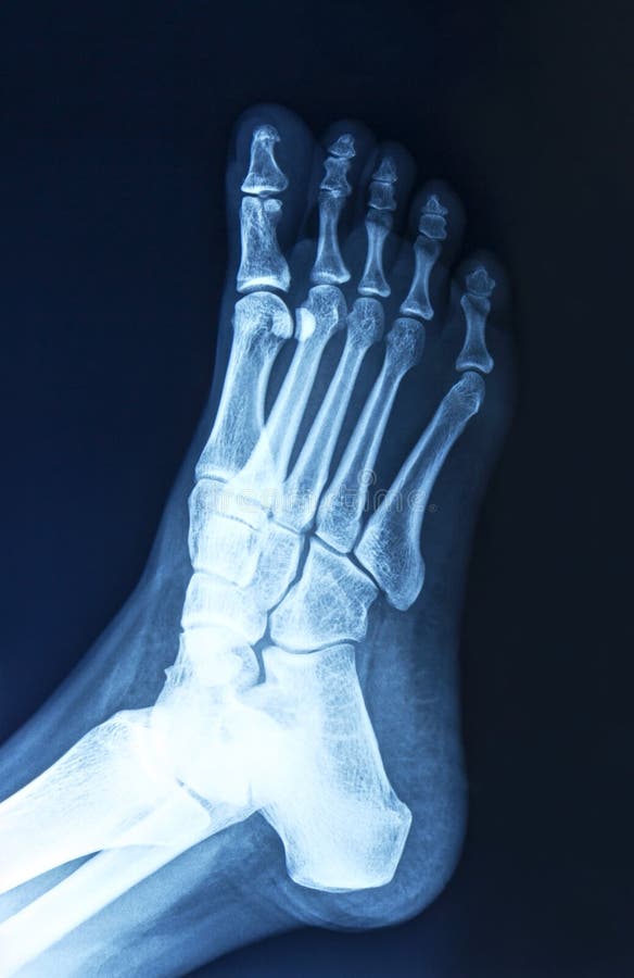 De Röntgenstraal Van De Voet, ZijMening Stock Foto - Image of ...