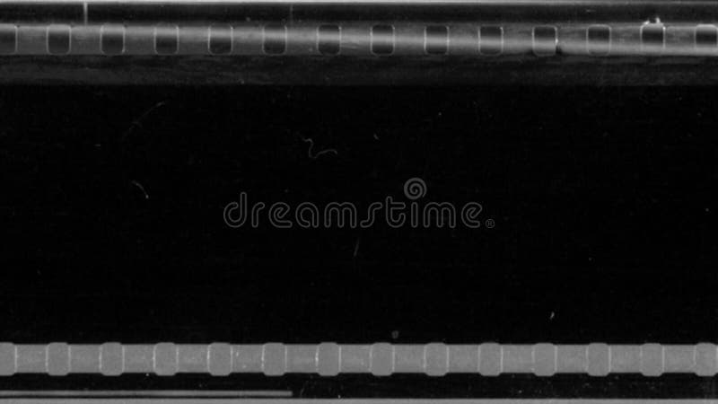 Film CT Scan Foot Showing Heel Bone Broken Calcaneus Fracture from Fall ...