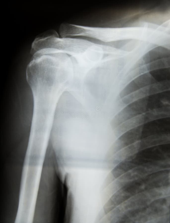 Film of shoulder stock photo. Image of disease, diagnosis - 69875768